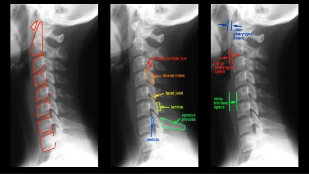 Spinal fractures classification - Core Surgical Trainees' teaching