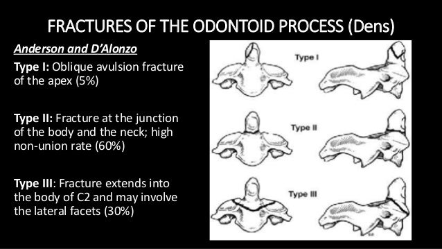 Spinal fractures classification - Core Surgical Trainees' teaching