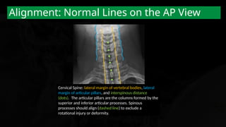 Spinal Fusion: Role of Perioperative Radiography | PPTX