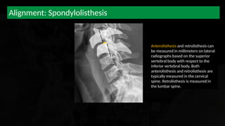 Spinal Fusion: Role of Perioperative Radiography | PPTX | Death, Injury ...