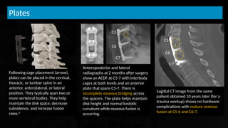 Spinal Fusion: Role of Perioperative Radiography | PPTX