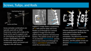 Spinal Fusion: Role of Perioperative Radiography | PPTX | Death, Injury ...