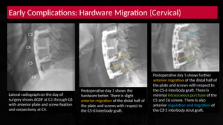 Spinal Fusion: Role of Perioperative Radiography | PPTX | Death, Injury ...
