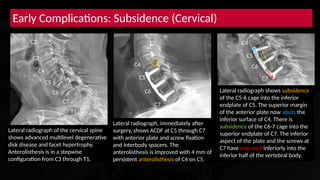 Spinal Fusion: Role of Perioperative Radiography | PPTX | Death, Injury ...