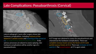 Spinal Fusion: Role of Perioperative Radiography | PPTX | Death, Injury ...