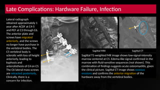Spinal Fusion: Role of Perioperative Radiography | PPTX | Death, Injury ...