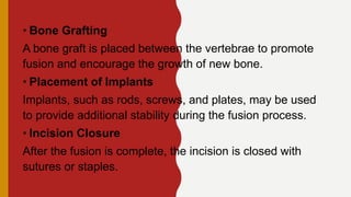 Spinal Fusion Surgery in Indore : Understanding the Procedure and ...