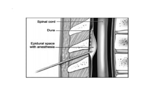 spinal headache or spinal puncture headache .pptx