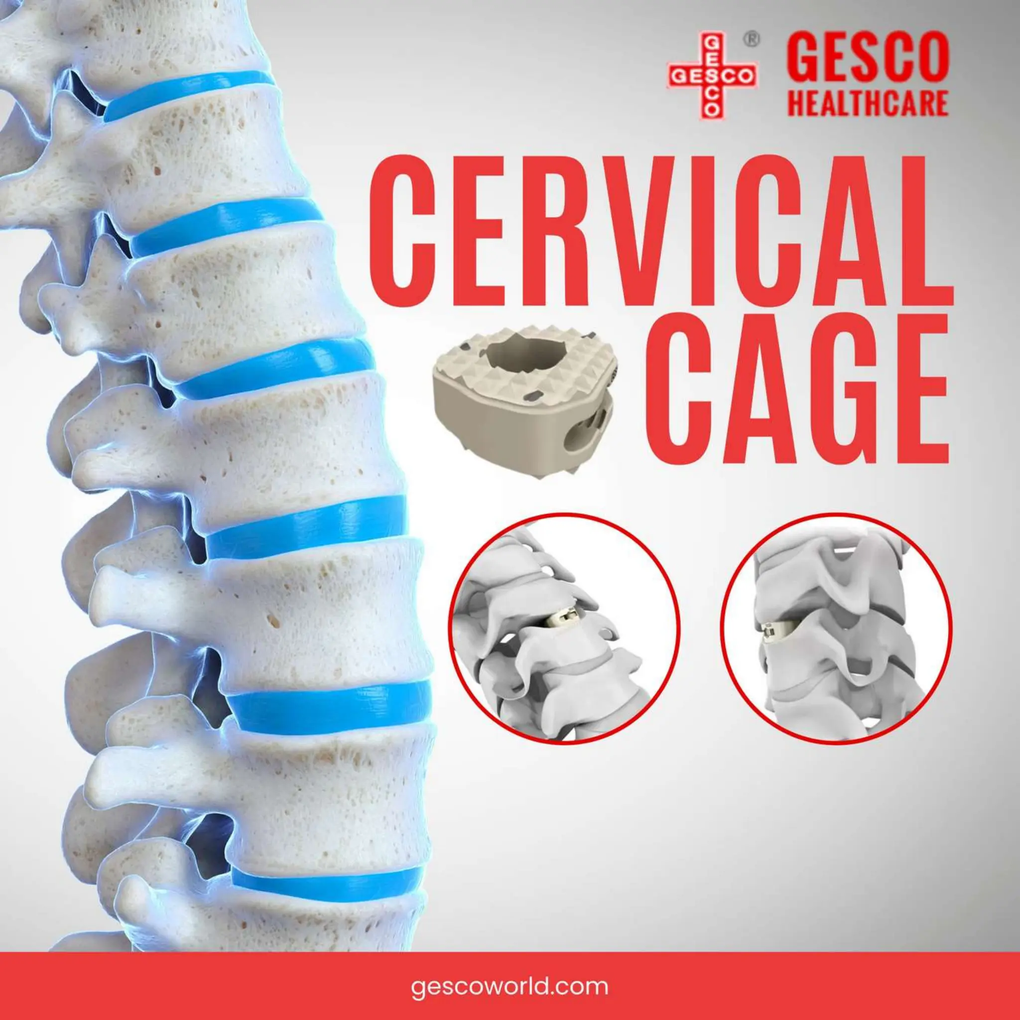 spinal implants | PPTX