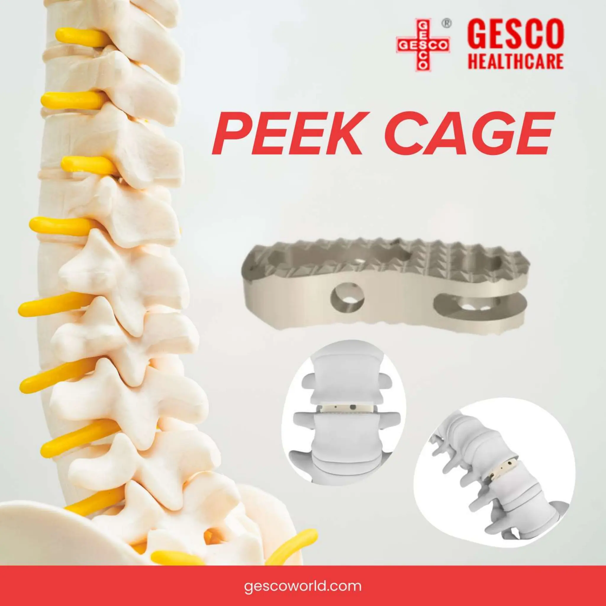 spinal implants | PPTX