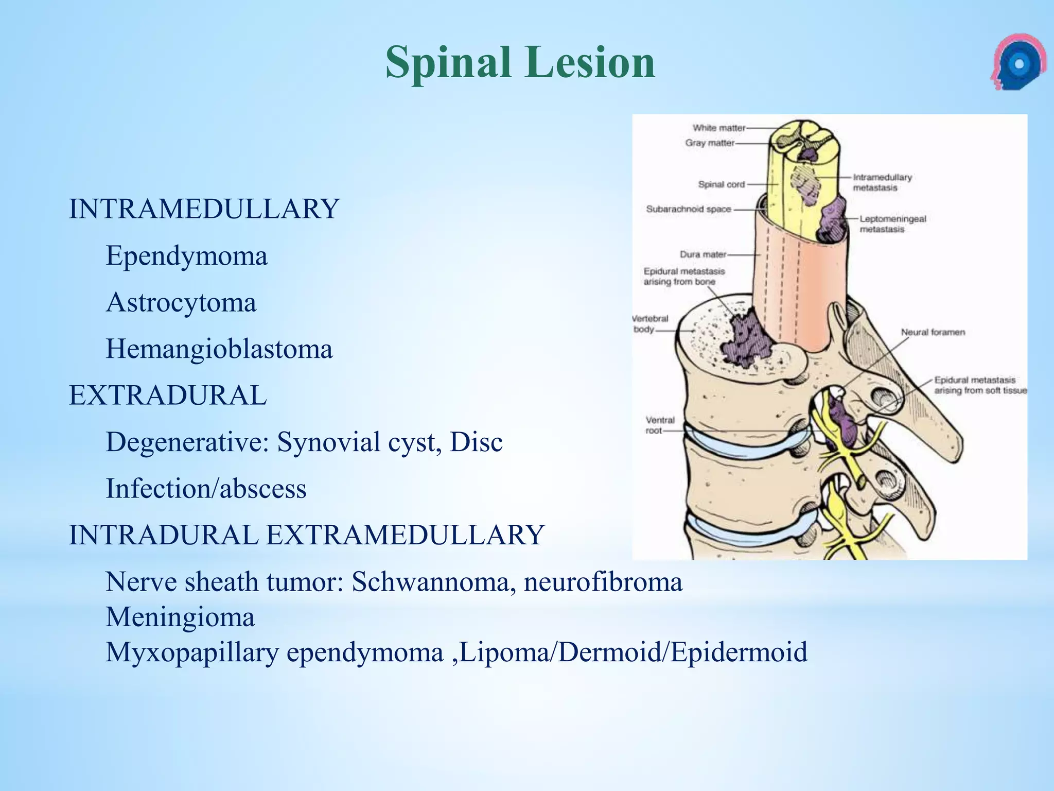 INTRAMEDULLARY TUMOR OF SPINAL CORD | PPTX