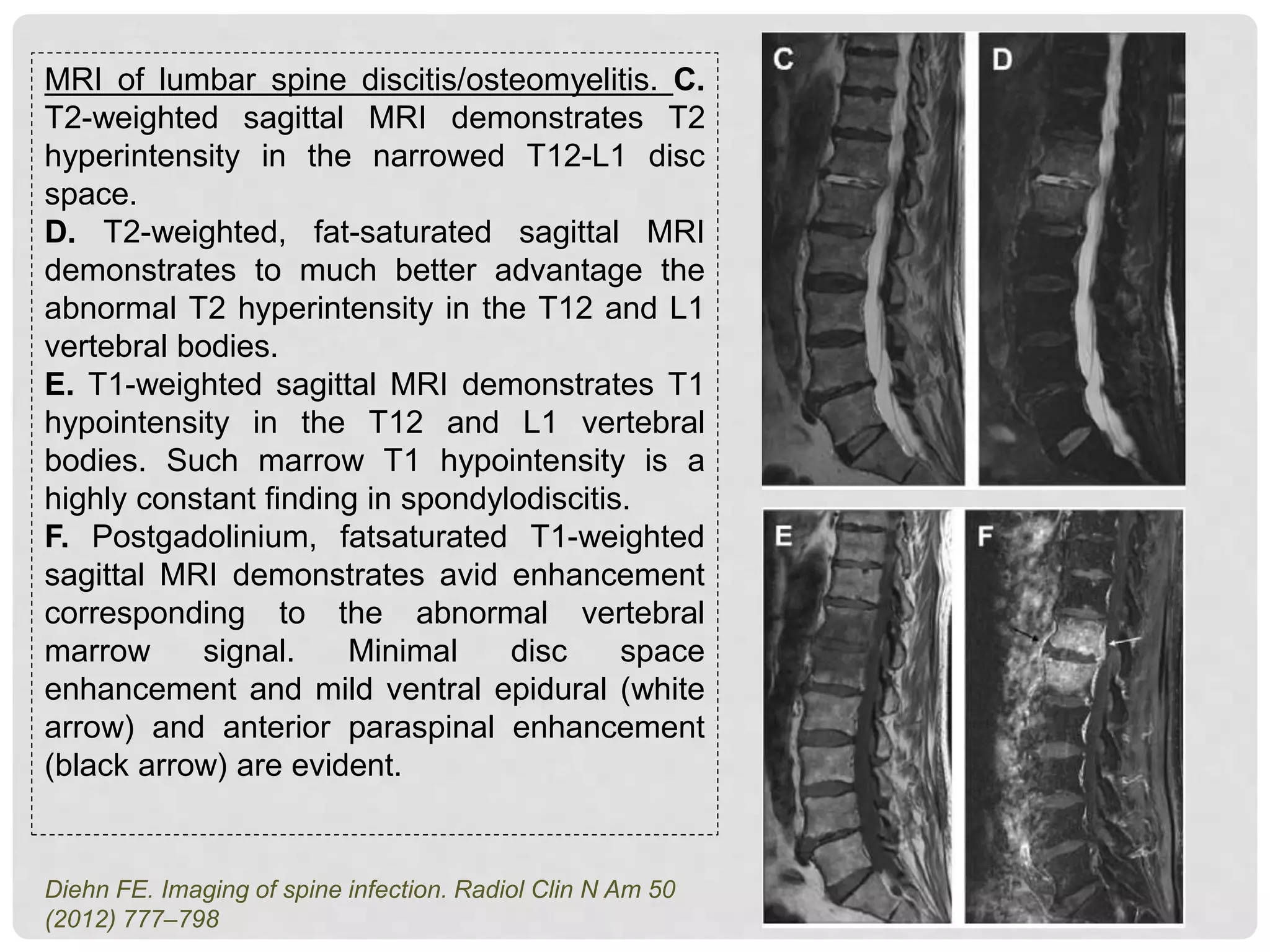 Spinal infection | PPTX