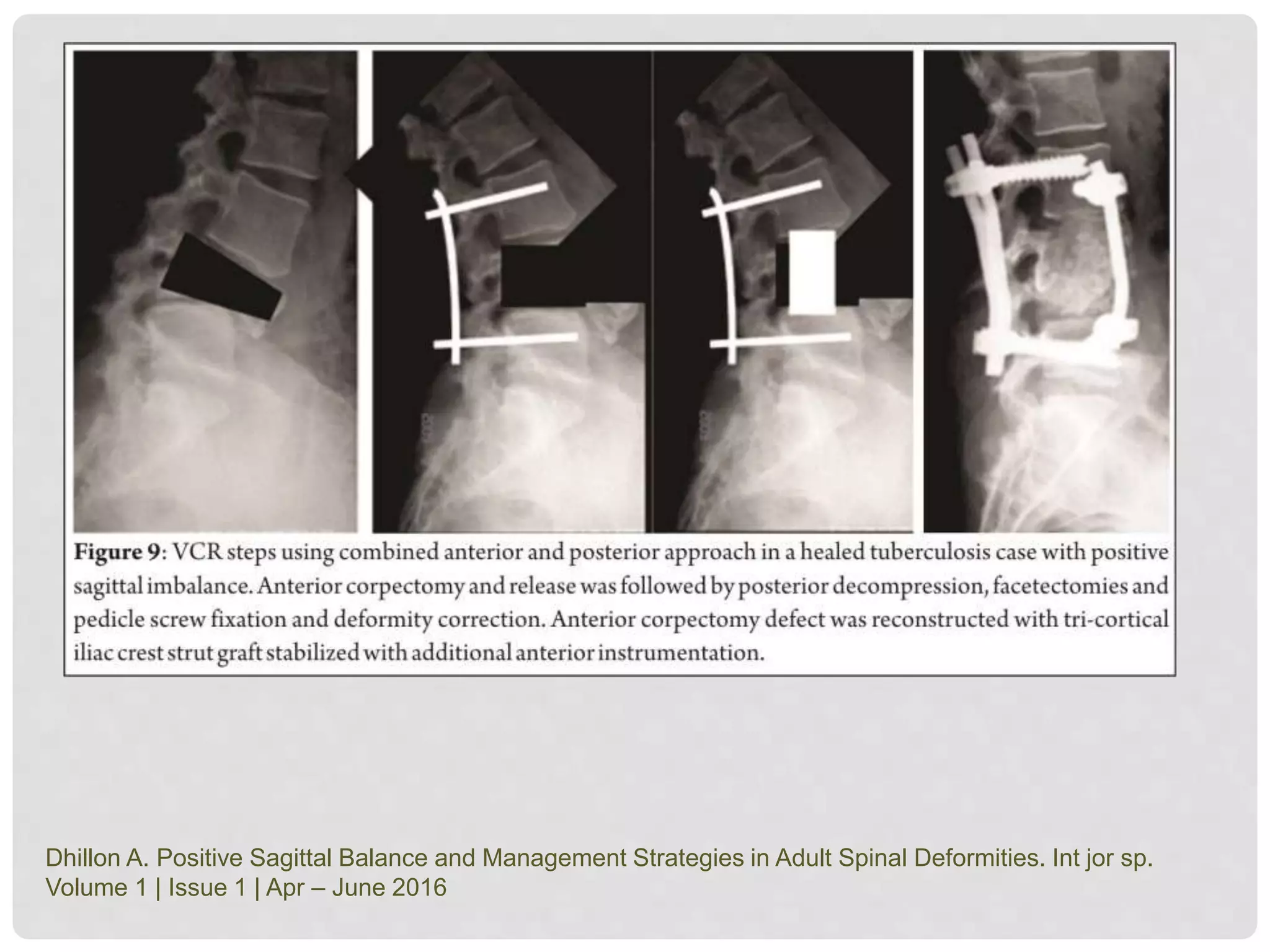 Spinal infection | PPTX