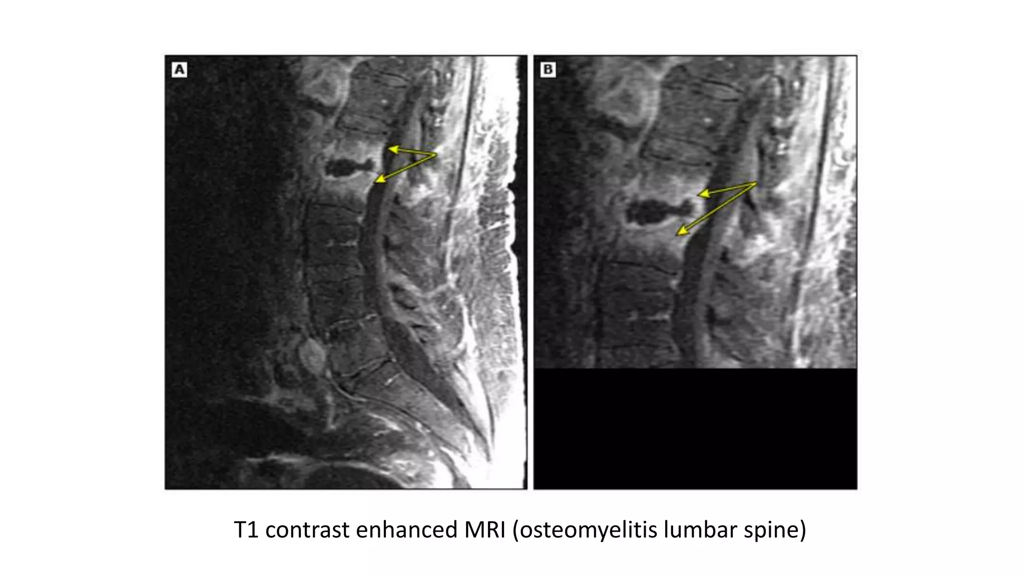 Spinal infections | PPTX