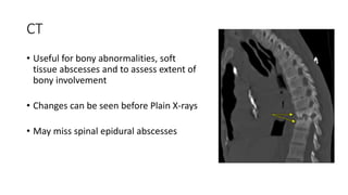 Spinal infections | PPTX