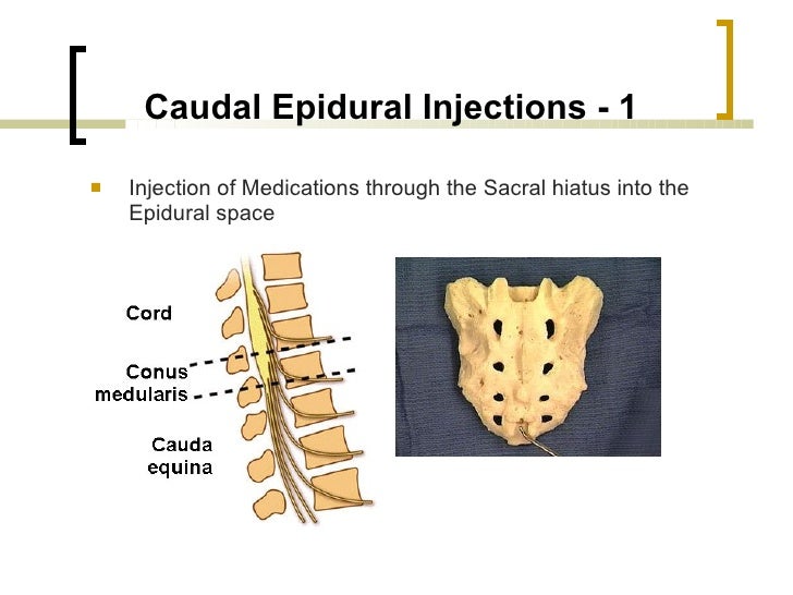 Spinal Injections