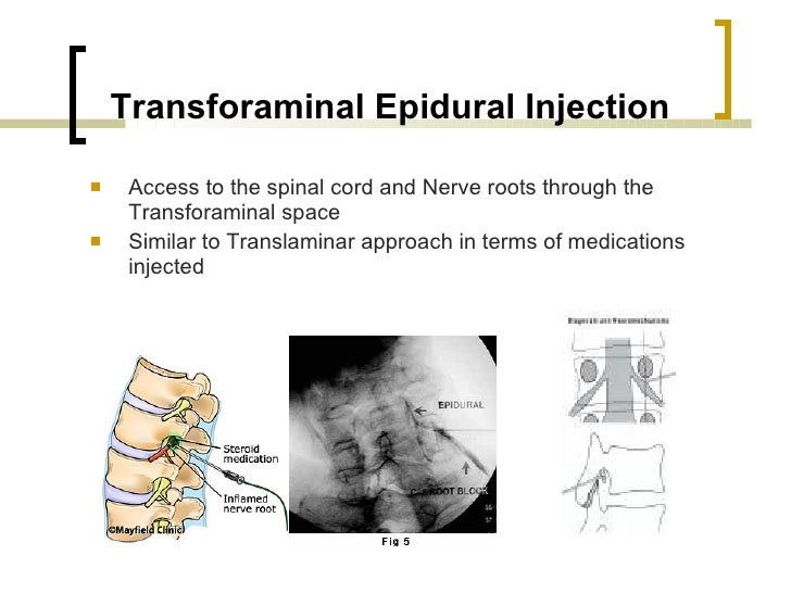 Spinal Injections