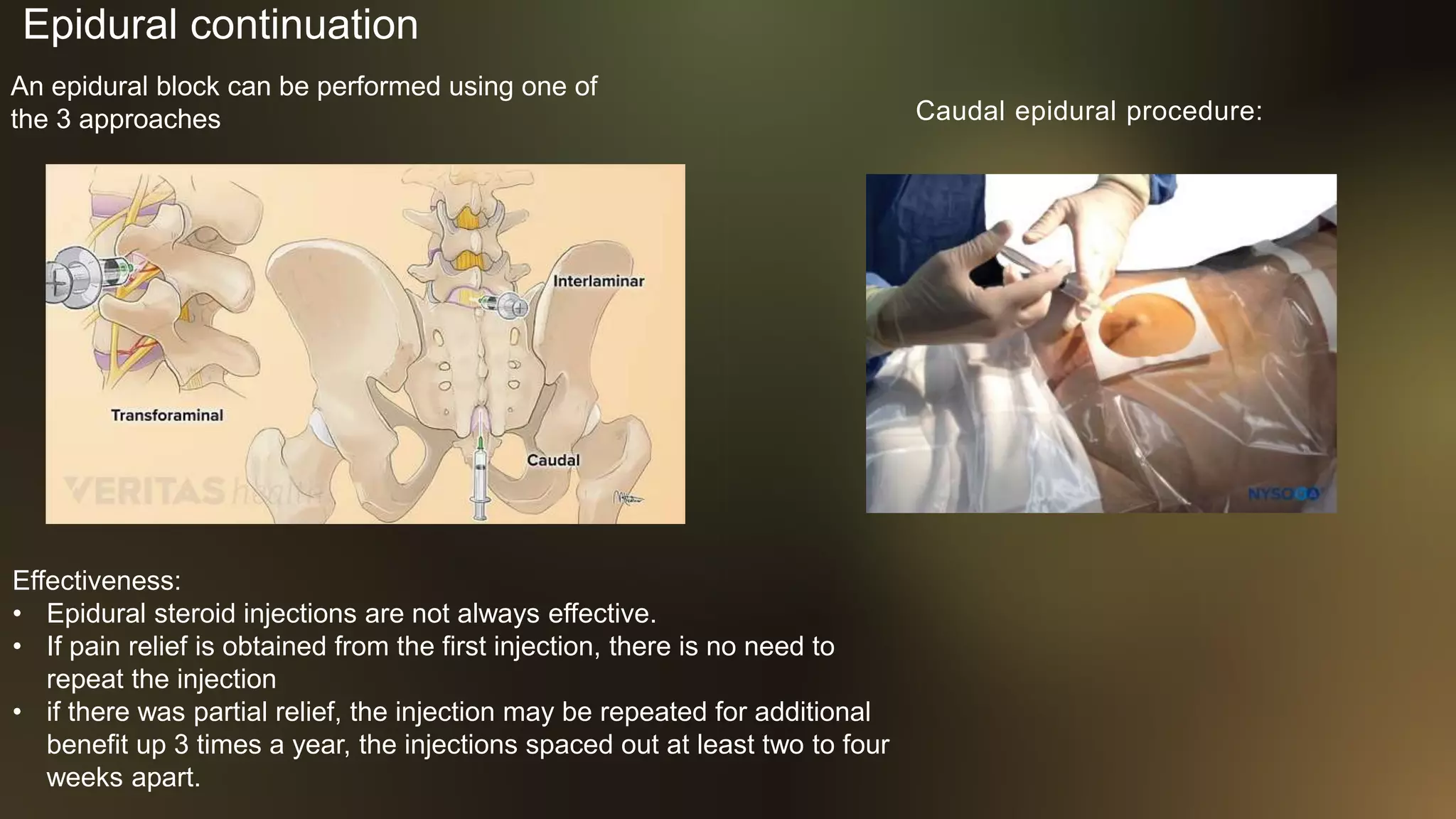 spinal injections.pptx