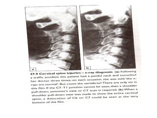 Spinal Injuries-a guide into the key concepts of spinal injuries | PPTX