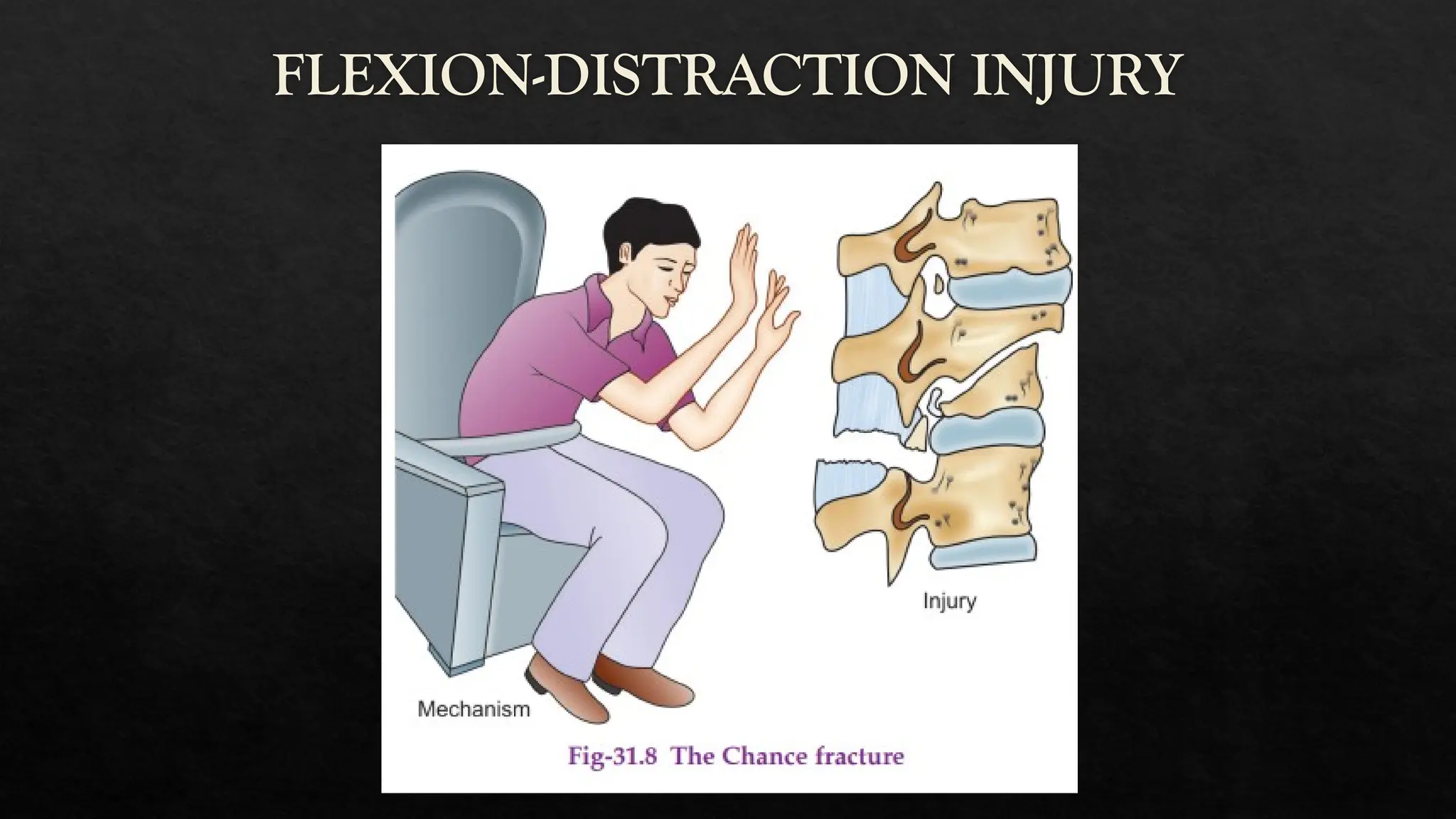 SPINAL INJURIES. Thoracolumbar and Cervical | PPTX