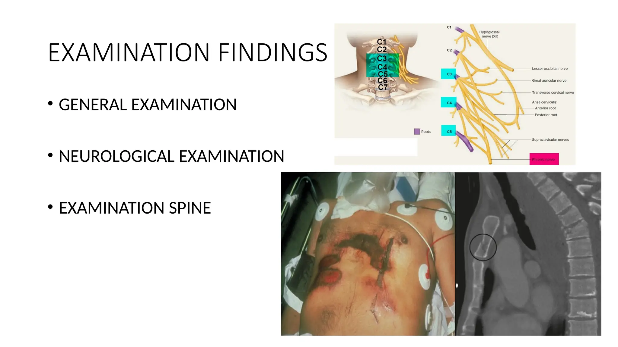 SPINAL INJURIES Anatomy three column concept log rolling investigation ...
