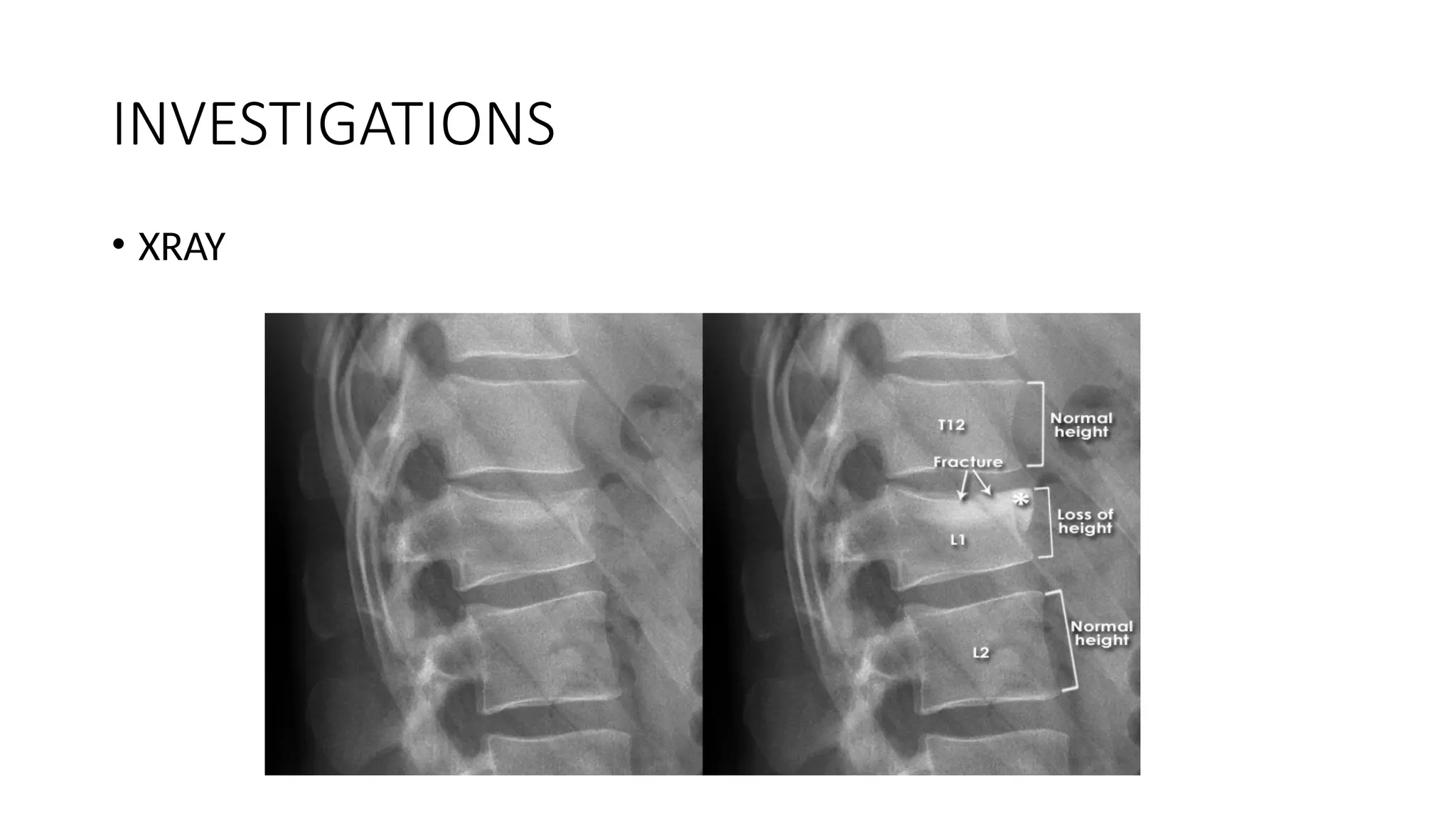 SPINAL INJURIES Anatomy three column concept log rolling investigation ...