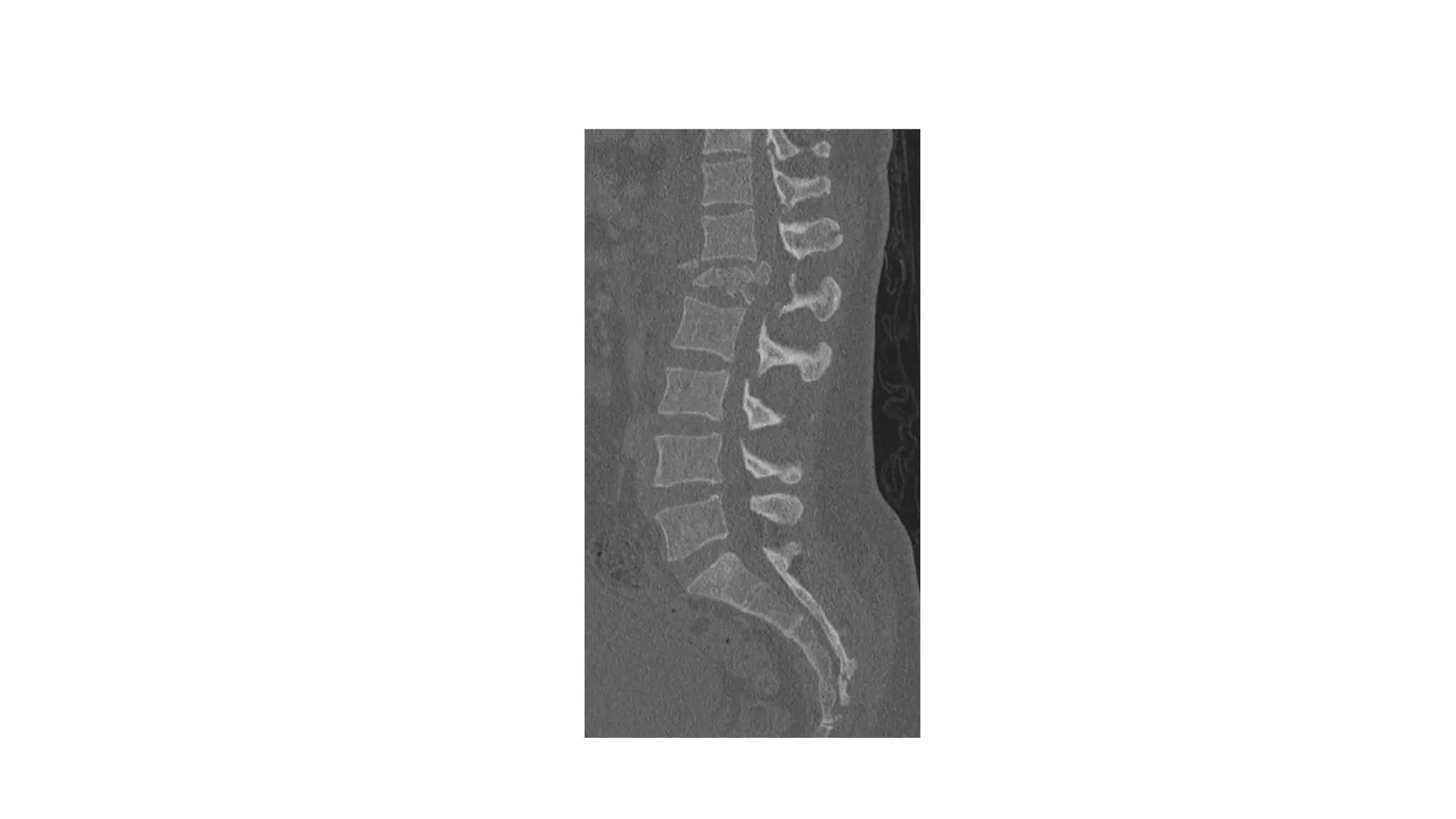 SPINAL INJURIES Anatomy three column concept log rolling investigation ...