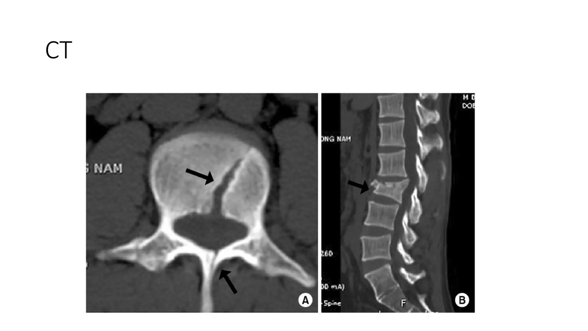 SPINAL INJURIES Anatomy three column concept log rolling investigation ...