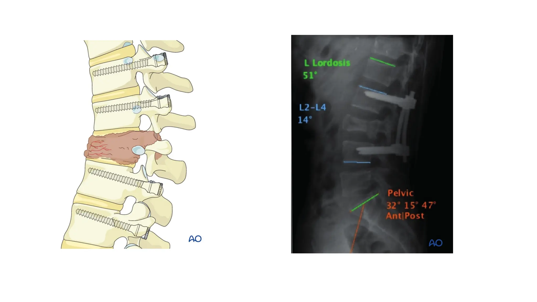 SPINAL INJURIES Anatomy three column concept log rolling investigation ...
