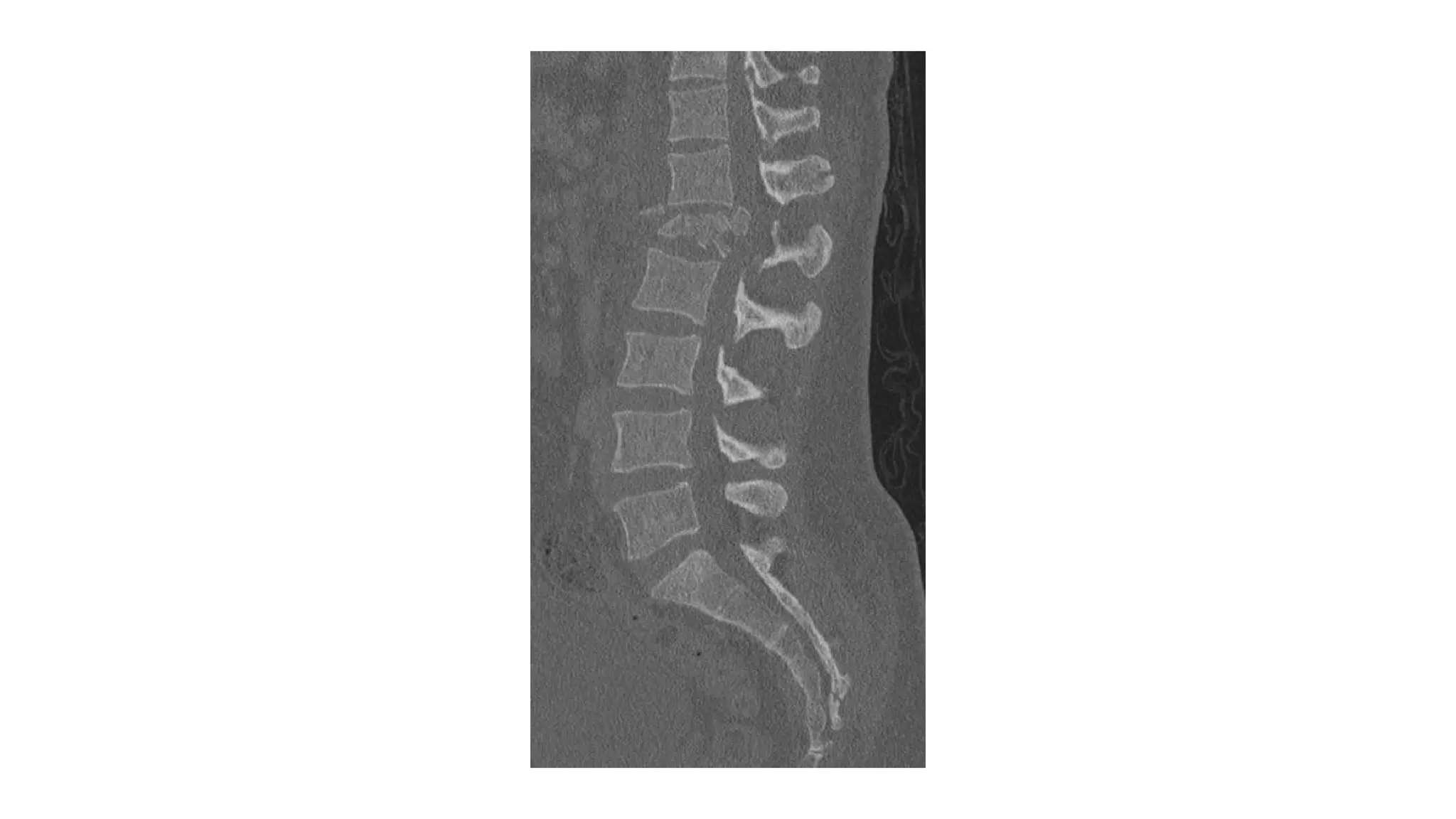 SPINAL INJURIES Anatomy three column concept log rolling investigation ...