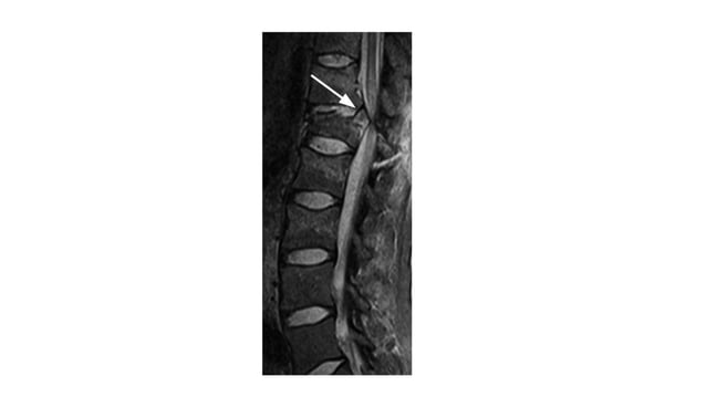 SPINAL INJURIES Anatomy three column concept log rolling investigation ...