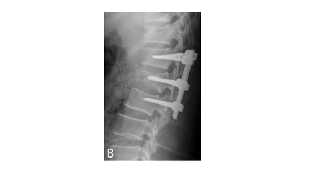 SPINAL INJURIES Anatomy three column concept log rolling investigation ...