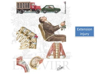 Spinal injuries1 | PPT