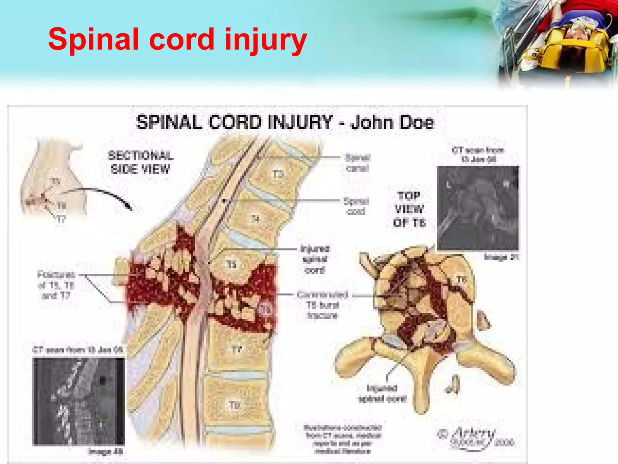 ‫Spinal injury | PPT