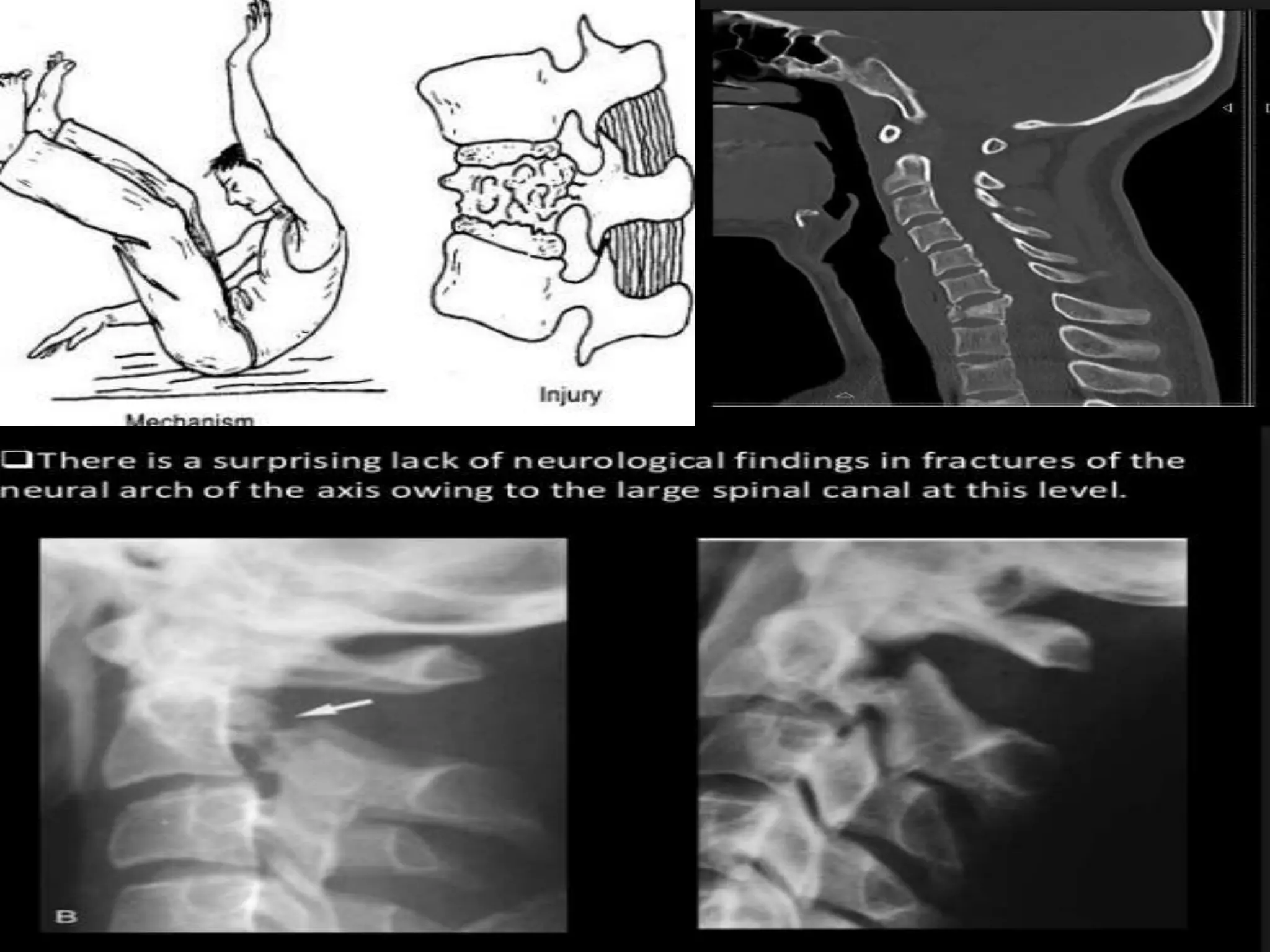 Spinal fractures (injury) | PPTX