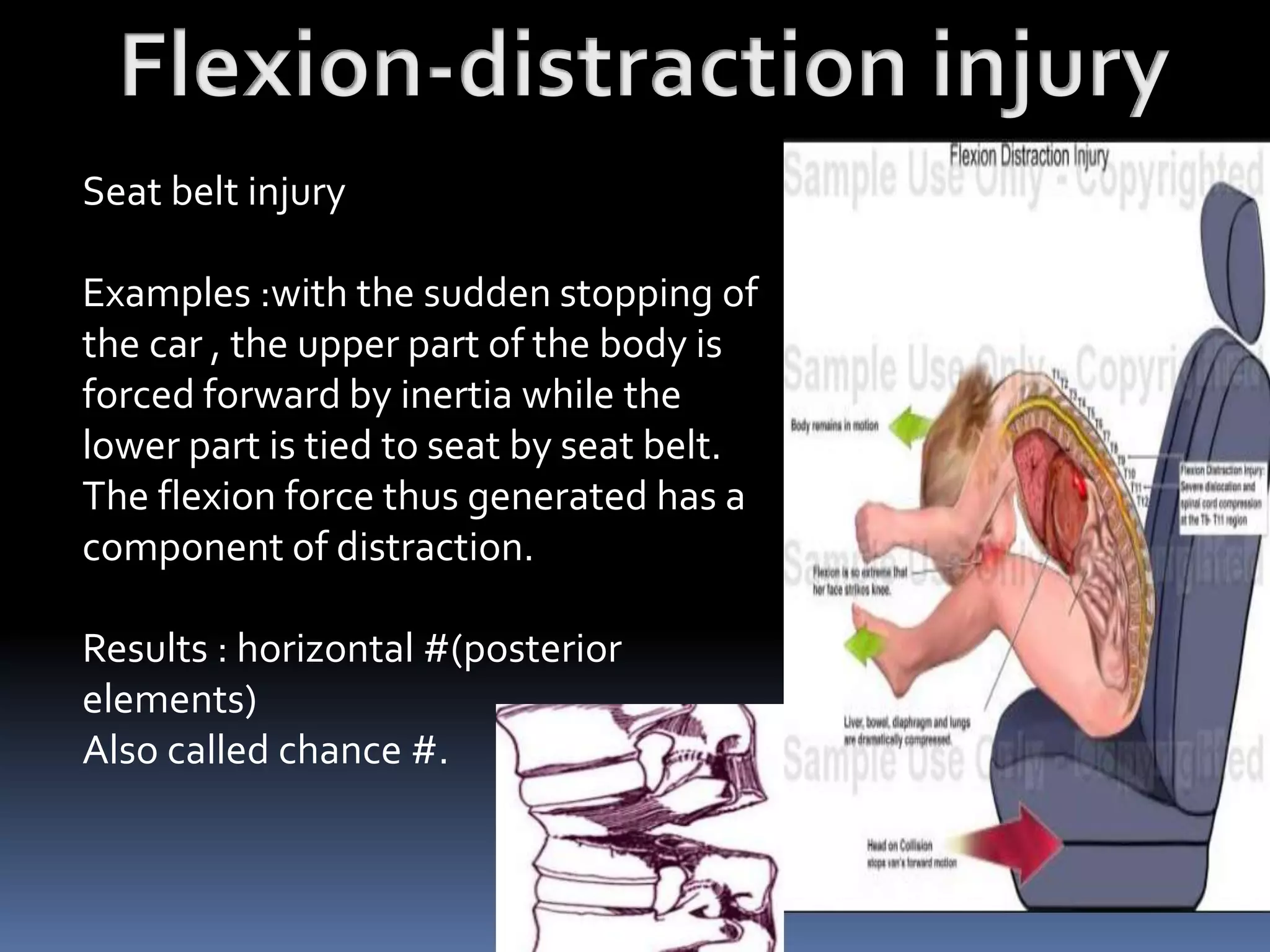 Spinal fractures (injury) | PPTX