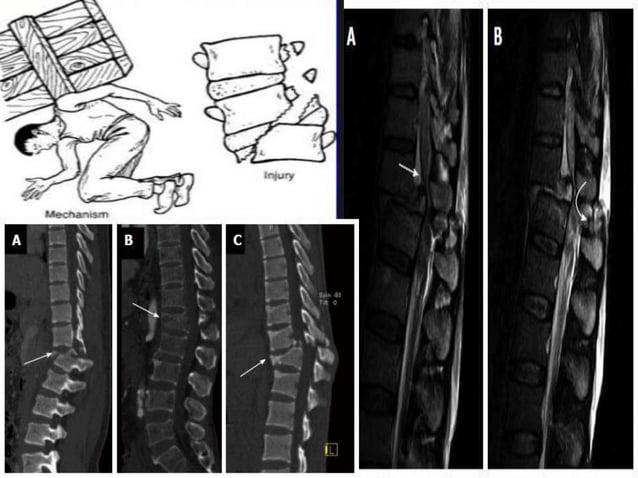 Spinal fractures (injury) | PPTX | Death, Injury, or Military Conflict ...