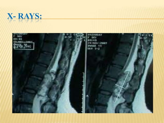 Spinal Injury Ppt Pptx