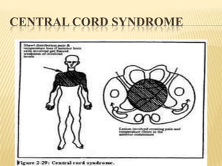 Spinal injury ppt | PPTX