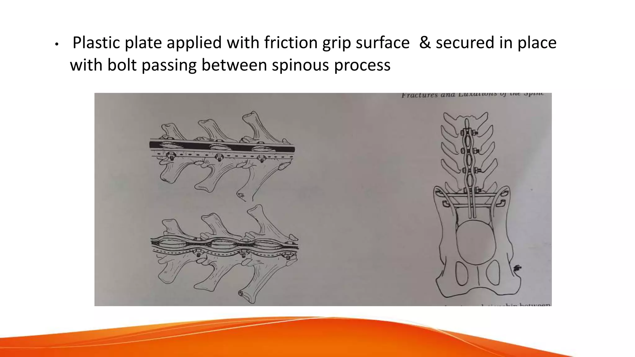 spinal instability...pptx