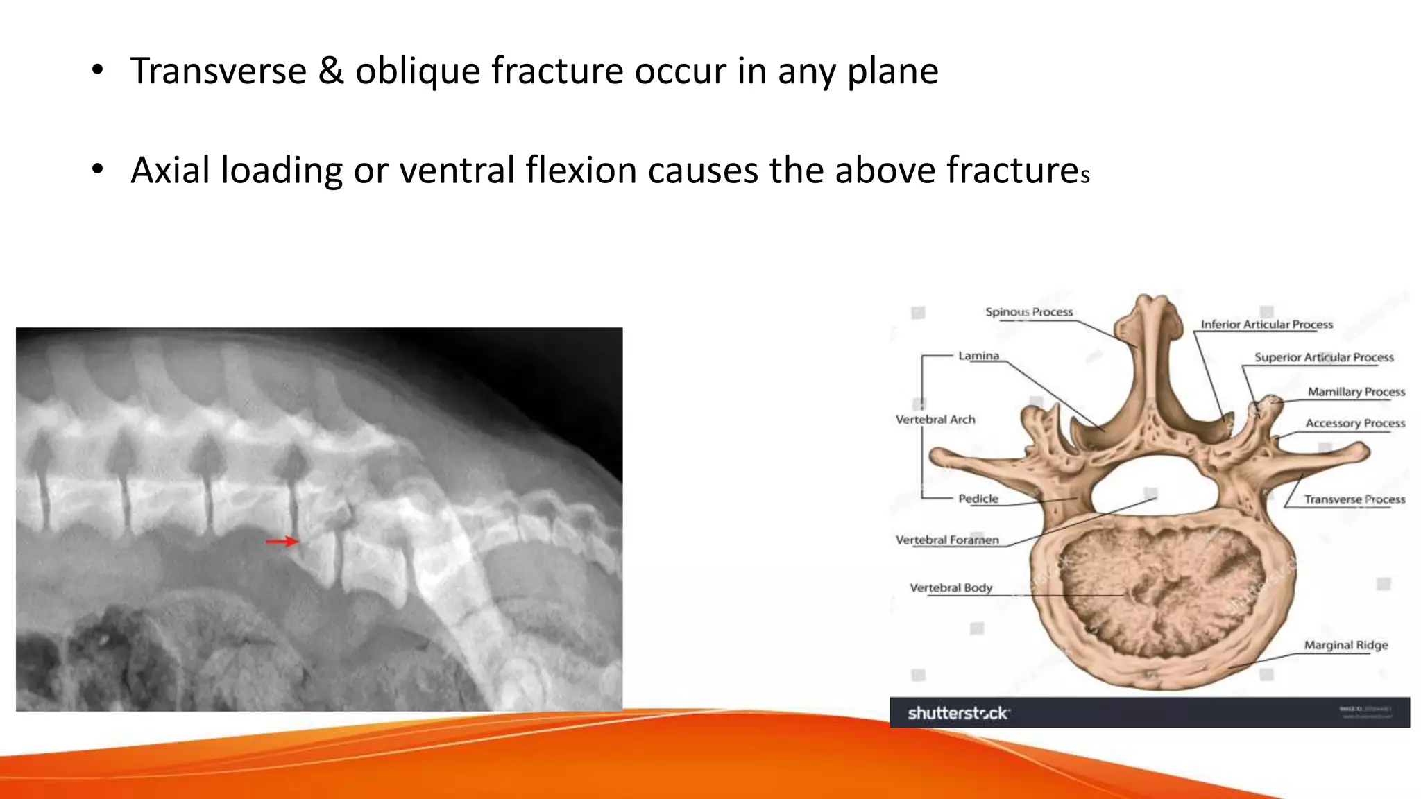 spinal instability...pptx