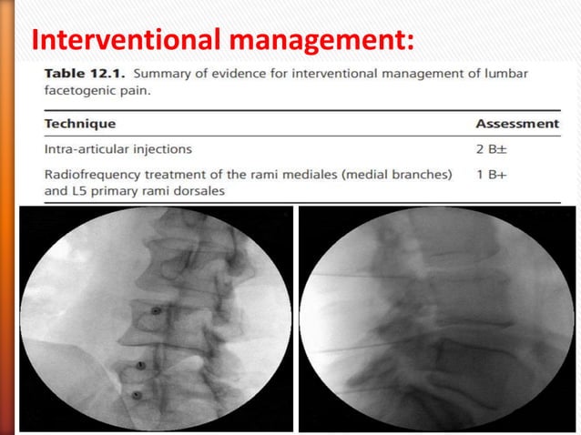 Spinal interventions for low back pain | PPTX