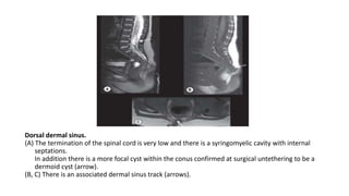 Spinal malformations | PPTX