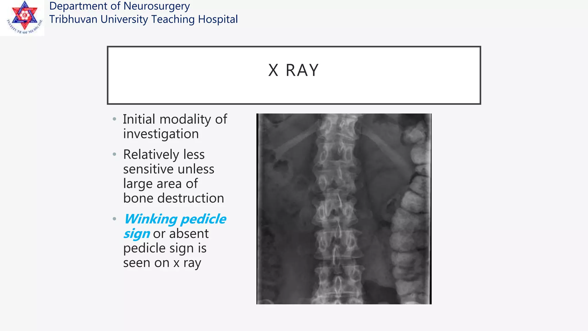 Management of Spinal Metastases | PPTX