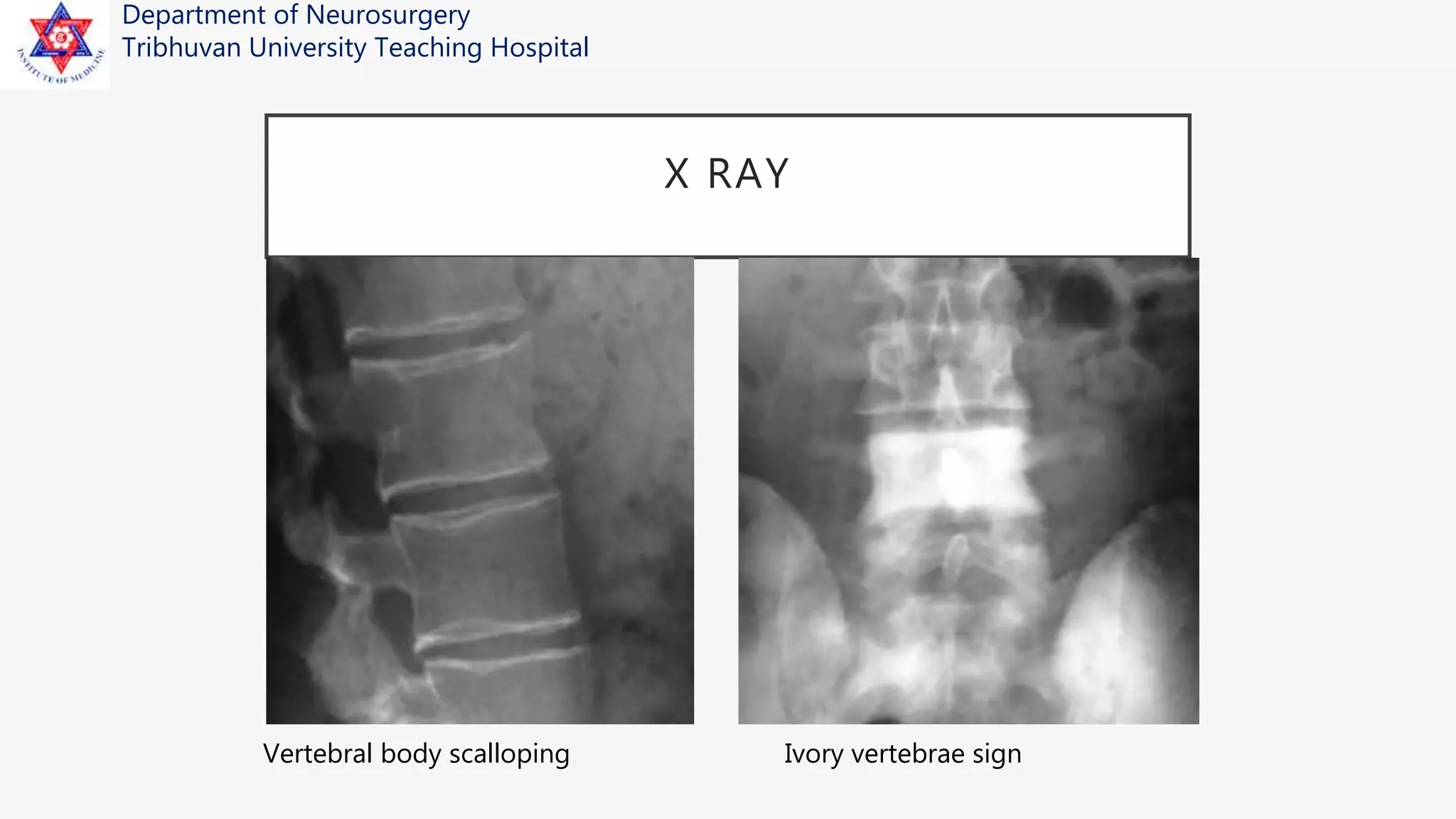 Management of Spinal Metastases | PPTX