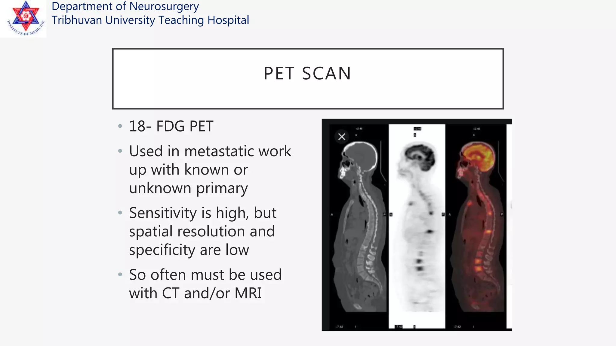 Management of Spinal Metastases | PPTX