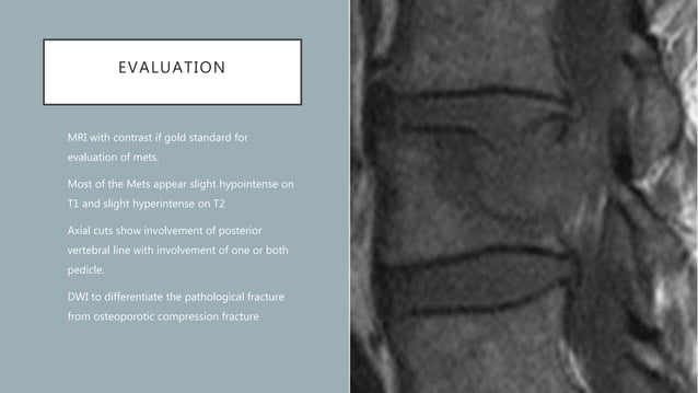 Management of Spinal Metastases | PPTX