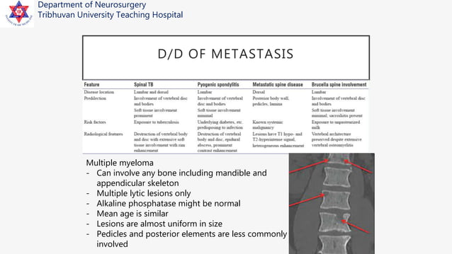 Management of Spinal Metastases | PPTX