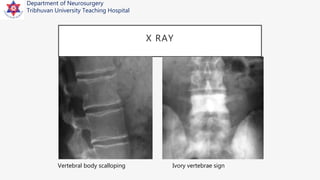Management of Spinal Metastases | PPTX