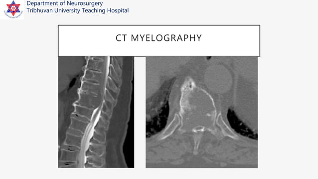 Management of Spinal Metastases | PPTX
